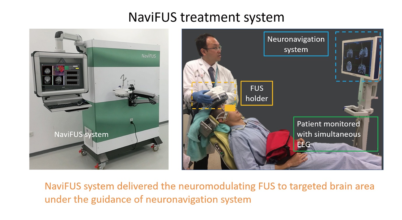 Ultrasound Treatment can Target Neural Circuits of Epilepsy - Quicknews