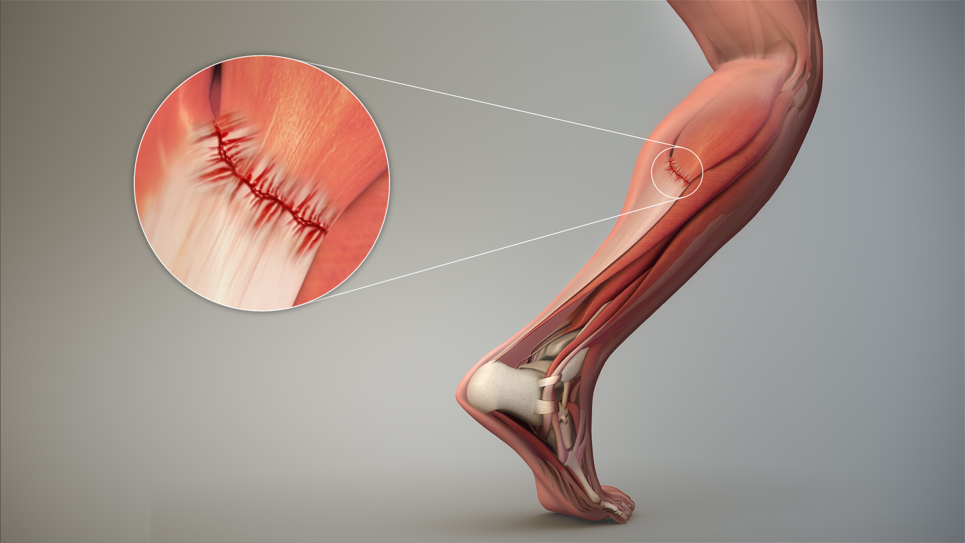 Study Sheds Light on Why Tendons Are Prone to Injury - Quicknews