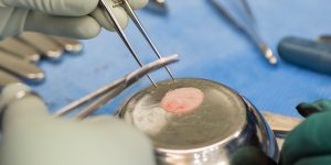 Engineered Cartilage from Nasal Septum Cells helps Treat Complex Knee ...